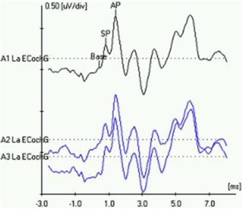 Electrocochleography Ecochg And Fistula Testing Flashcards Quizlet