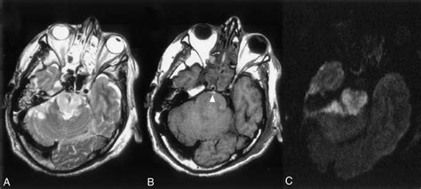 Axial MR Images A T2 Weighted Image Shows Hyperintensities In The