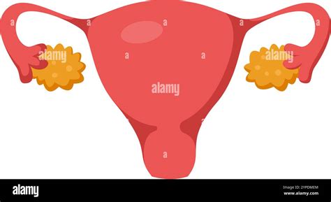 Medical Illustration Representing Female Reproductive Organs Including Uterus Fallopian Tubes