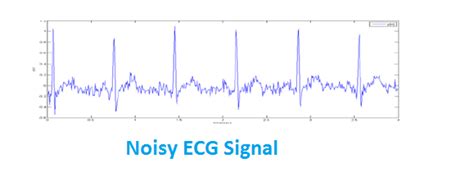 ECG Averaging In MATLAB The Engineering Projects