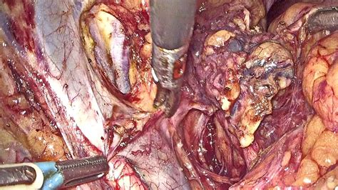 Post Radiotherapy Pelvic Lymphadenectomy Dr Jay Mehta Youtube