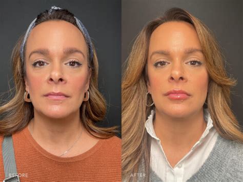 What To Expect Lip Filler Before And After At Personal Touch Aesthetic Article Terrain