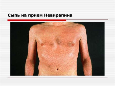Кожные проявления при ВИЧ инфекции коинфекции ВИЧ ВГ презентация онлайн