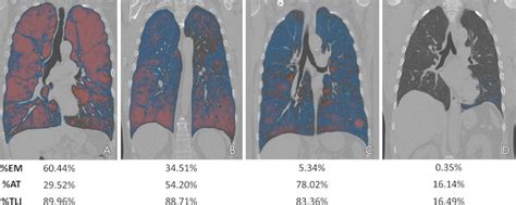 Ai Algorithm Can Predict Severity Progression Of Copd Auntminnie Ai Algorithm Can Predict Severity Progression Of Copd Auntminnie