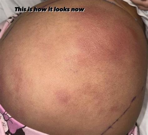 Cellulitis After Filler Rbotchedsurgeries