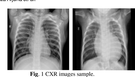 Figure 1 From Lung Chest X Ray Image Segmentation For Detection Of