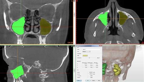 Segmentation And Three Dimensional Configuration Of Maxillary Sinus