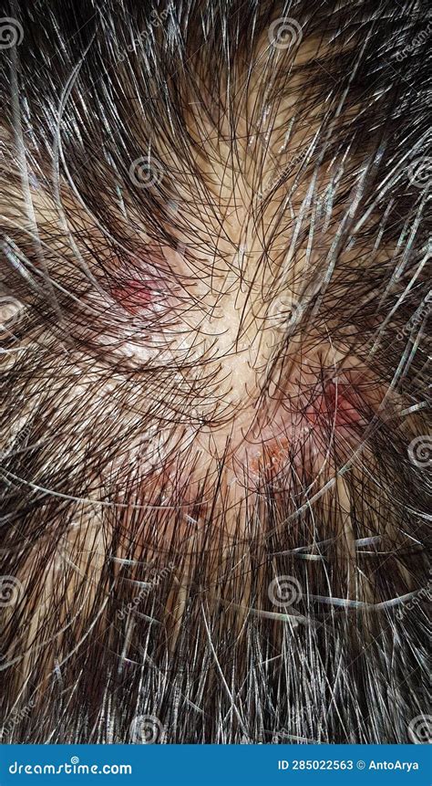 Scabs On The Scalp Wound On The Scalps Or Lichen Planus Follicularis Scabs On The Scalp Wound On The Scalps Or Lichen Planus Follicularis