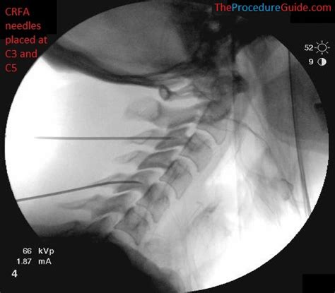 Fluoroscopic Guided Sacroiliac Sij Joint Injection Technique And