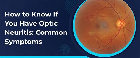 How To Know If You Have Optic Neuritis Common Symptoms