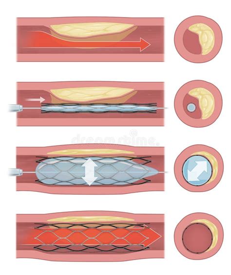 Plaque Formation In Artery Stock Vector Illustration Of Media 10836470