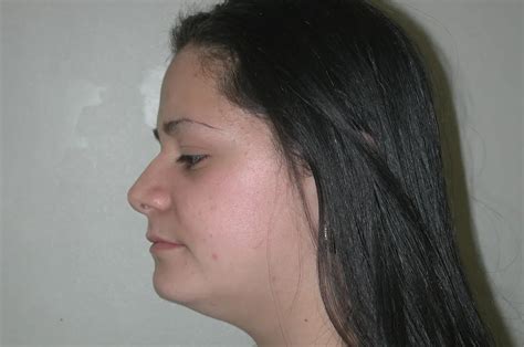 Upper Maxilla Surgery Rancho Santa Margarita Ca Orange County