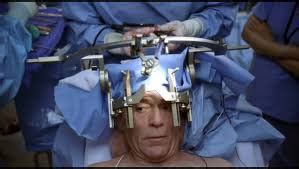 Awake Craniotomy