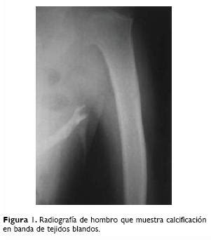 Miositis Osificante Progresiva Con Buena Respuesta A Tratamiento Con