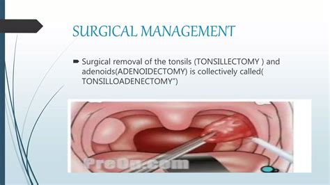 Tonsillitis Slideshare For Medical Students Pptx