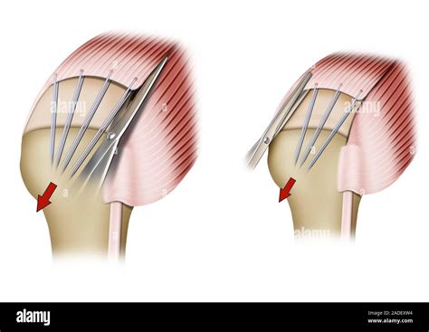 Rotator Cuff Shoulder Surgery Illustration The Rotator Cuff Is A Group Of Muscles And Tendons