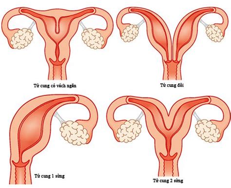 Tử Cung Có Vách Ngăn Nguyên Nhân Triệu Chứng Và Cách Điều Trị Hiệu Quả