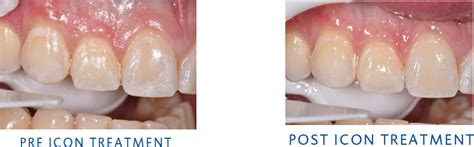 Post Orthodontic White Spots Treatment With Icon Dmg America