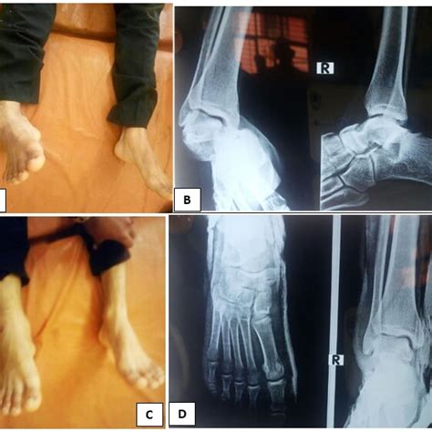Post Op Plain X Ray Ap And Lateral View Showing Congruent Reduction Download Scientific