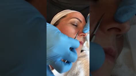 Dermaplaning Youtube