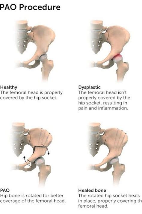 Congenital Hip Dysplasia Treatment In Kenya Orthopedic Care In Nairobi