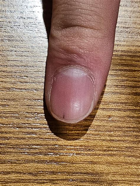 손톱 검은색 점 지식in