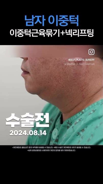 남자 이중턱지방흡입근육묶기넥리프팅목거상 한달 전후 비교 후기 Shorts 이중턱 이중턱근육묶기 Youtube