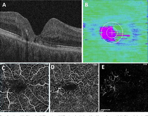 Figure 1 From Oct Angiography And Ellipsoid Zone Mapping Of Macular