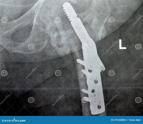 Left Hip Trans Cervical Neck Of Femur Fracture Fixated By Dhs Dynamic