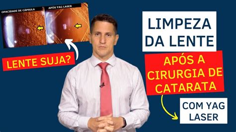 Limpeza da lente após cirurgia de catarata Yag laser Dr Arthur