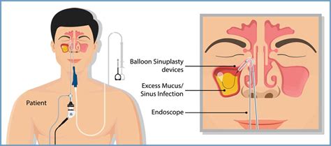 Endoscopic Sinus Surgery Yellowstone Surgery Center