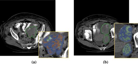 Examples Of CT Images With The Pelvic Lesions Outlined By The Green Download Scientific Diagram