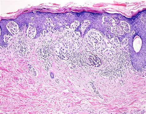 Melanoma Depth Of Invasion Light Micrograph Stock Image C051 1622 Science Photo Library