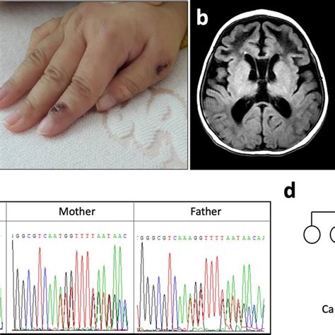 Clinical Features And Genetic Analysis Of Case 1 A Chilblain Lupus Download Scientific Diagram