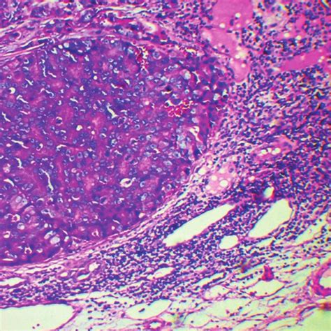 Pdf Left Supraclavicular Lymphadenopathy As The Only Clinical