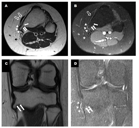 Medial Hamstring Snapping Knee Syndrome Case Report Of An Unusual