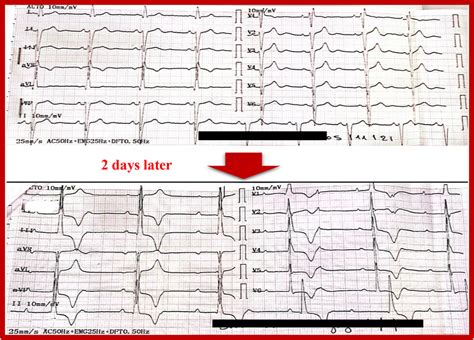 A Bifascicular Block Combining A Right Bundle Branch Block Rbbb With Download Scientific