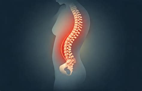 Trunk Rotation Archives Treating Scoliosis