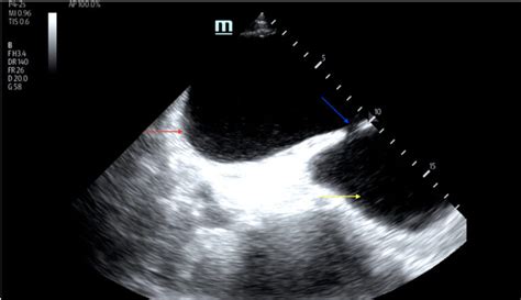 Bladder Diverticulum Us 2 Annotated Jetem 2020 Jetem