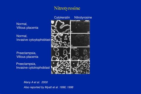 Complex Multisystemic Features Of Preeclampsia Ppt Download