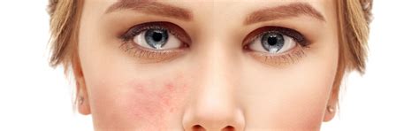 Papulopustular Rosacea Treatment In Gainesville Fl
