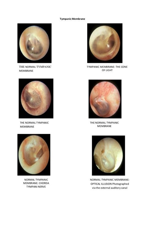 Tympanic Membrane Dr Fadil