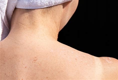 Home Remedies For Peeling Skin Top 10 Home Remedies