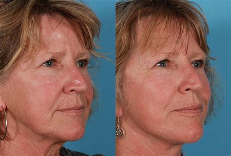 Patient 130114 Limited Incision Facelift Before And After Photos Buckingham Center For Facial