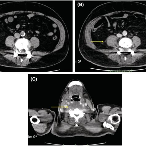 Abdominal Ct Scan Without Contrast‐enhancement On Admission Reveals A