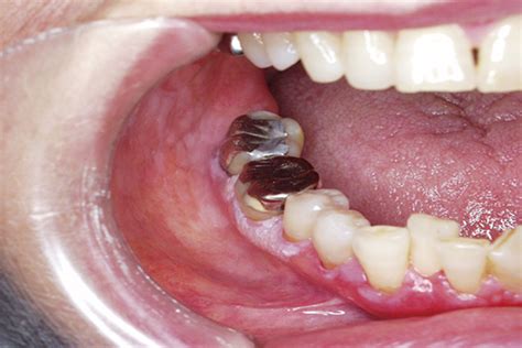 【お口の中の病気】口腔がんセルフチェック 一般社団法人 青森県歯科医師会