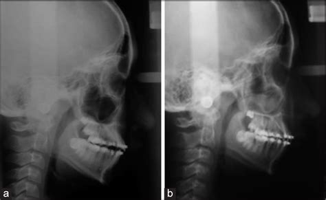 Management Of Skeletal Class Iii Malocclusion With Unilateral Crossbite On A Growing Patient