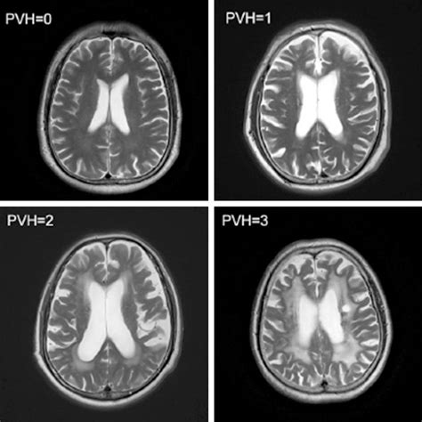 Representative Mri Images Showing Periventricular Hyperintensity