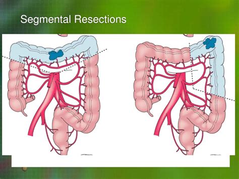 Ppt Colorectal Cancer Powerpoint Presentation Free Download Id 5290649