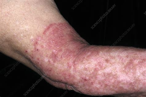 Ringworm Stock Image C0596956 Science Photo Library